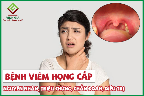 Viêm họng cấp là gì? Nguyên nhân, dấu hiệu và cách điều trị