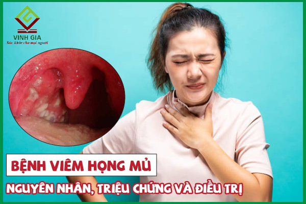 Nguyên nhân gây viêm họng có mủ và cách điều trị hiệu quả