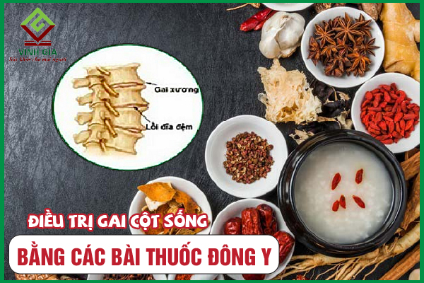 Tổng hợp 6 bài thuốc đông y chữa gai cột sống hiệu quả