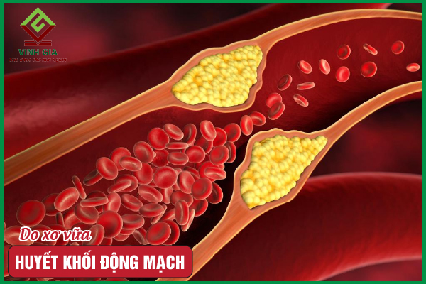Nguyên nhân và điều trị huyết khối động mạch do xơ vữa