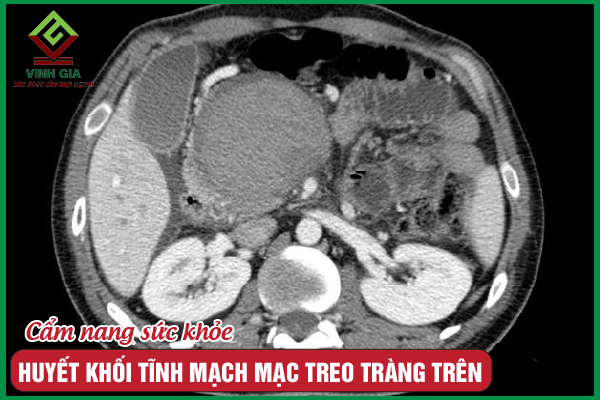 Hiểu rõ về huyết khối tĩnh mạch mạc treo tràng trên