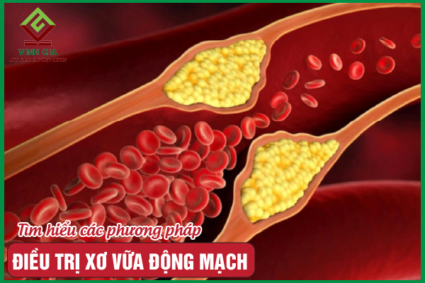 5 phương pháp điều trị xơ vữa động mạch tốt nhất hiện nay